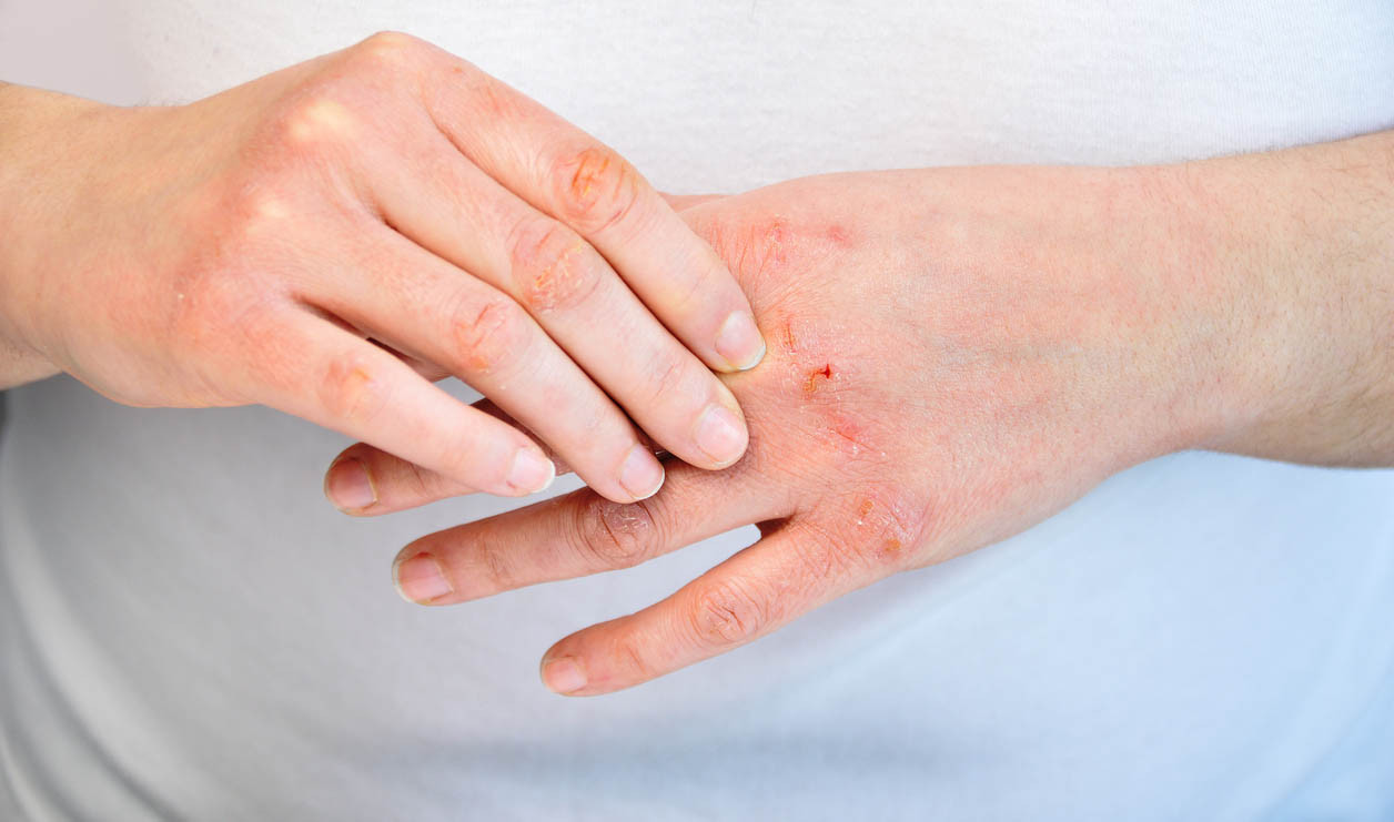 Alergi - Penyebab, Gejala, & Pengobatan | HonestDocs