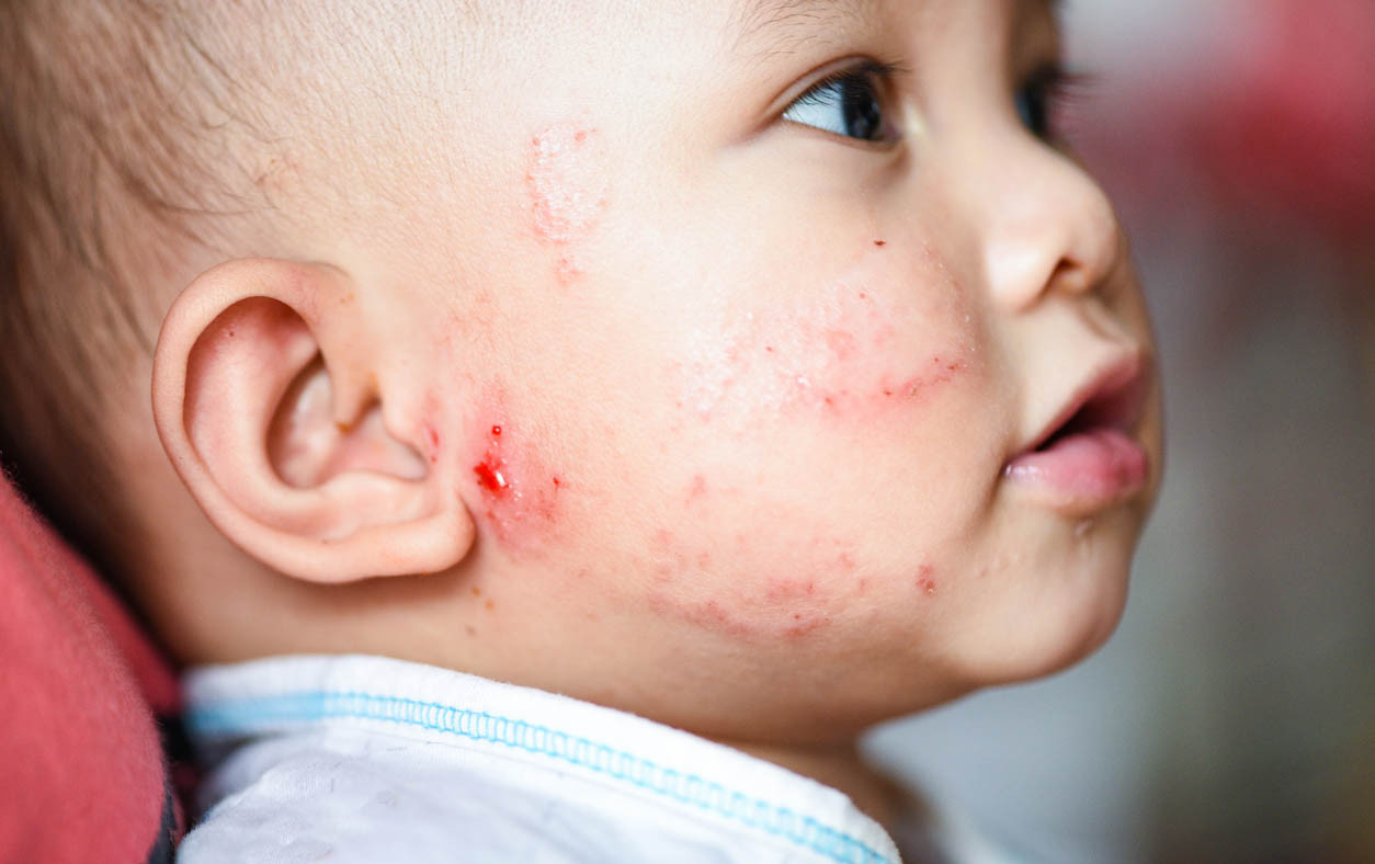 Dermatitis Atopik: Gejala, Penyebab, dan Pengobatan | HonestDocs