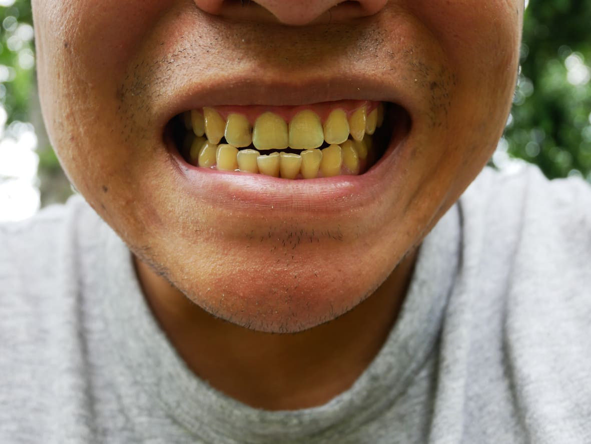 Tips Mengatasi Masalah Gigi dan Bibir bagi Perokok | HonestDocs
