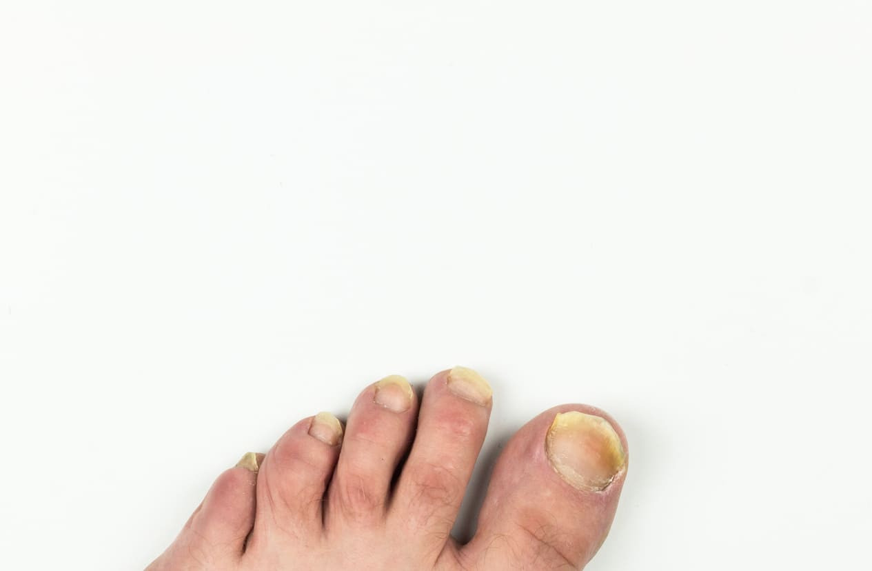 Diabetes Penyebab Kuku Kuning | HonestDocs