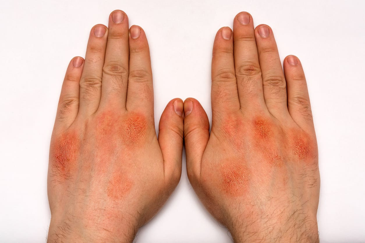 Antiphospholipid Antibody Syndrome Adalah? - Tanda, Penyebab, Gejala ...