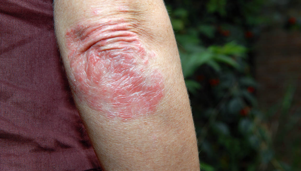 Neurodermatitis Adalah? - Tanda, Penyebab, Gejala, Cara Mengobati ...