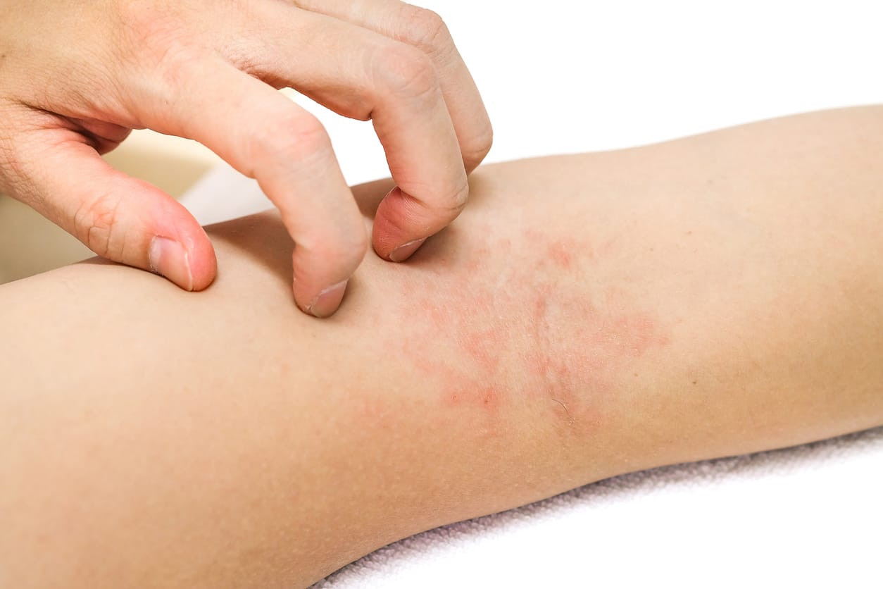 Dermatitis Numularis Adalah? - Tanda, Penyebab, Gejala, Cara Mengobati ...