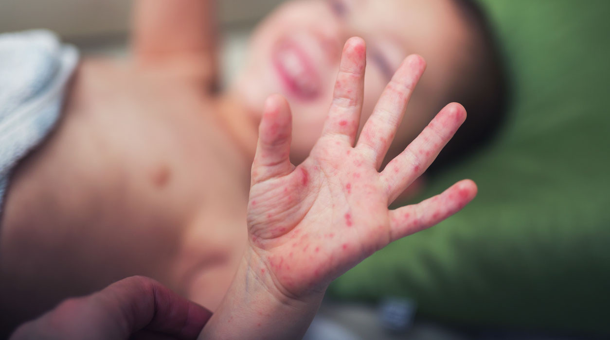 Rubela Pada Anak Adalah? - Tanda, Penyebab, Gejala, Cara Mengobati ...